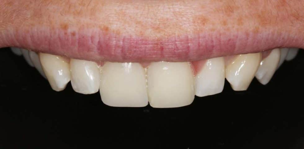 What is Composite Bonding? - Eilertsen Dental Care