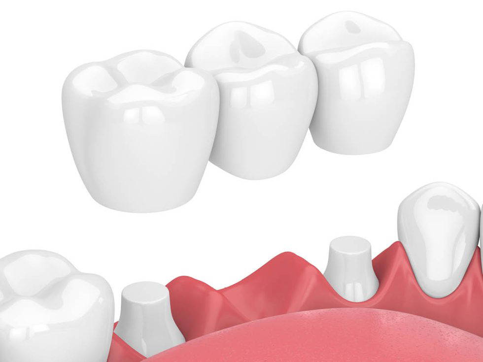 What is a Dental Crown and Bridge? - Eilertsen Dental Care